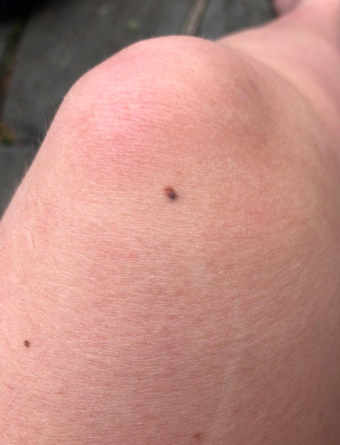 Mole turned into stage 3 melanoma in a month